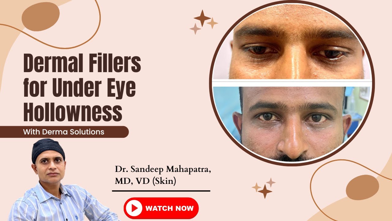 Under Eye Fillers | Dermal Fillers | Under Eye Filler Treatment | Derma Solutions - YouTube