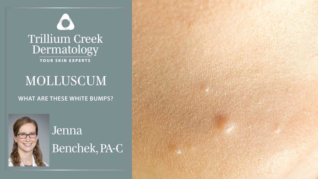Molluscum with Jenna Benchek, PA-C at Trillium Creek Dermatology - YouTube