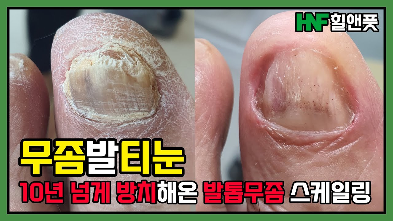 [ASMR] 무좀발티눈 / Fungal Foot Corn / 티눈 / Corn / 무좀 / Athlete's foot / 내성 ...