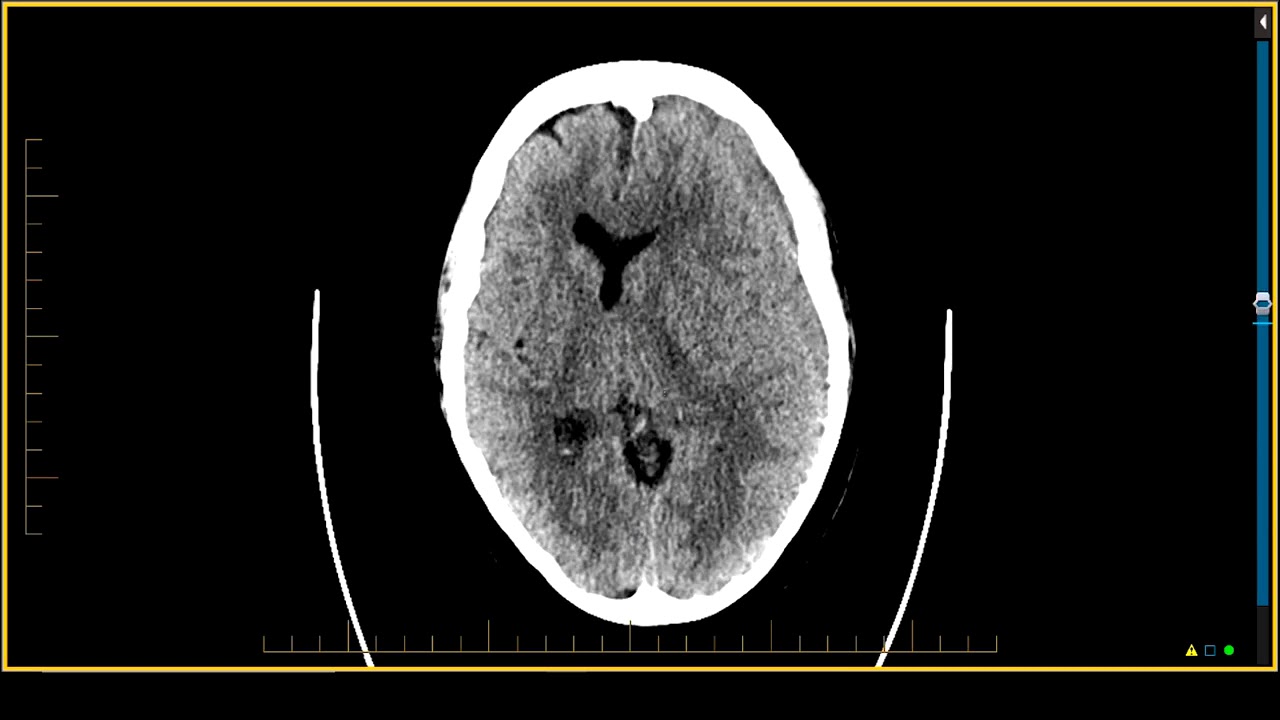Midline Shift MRI Online - YouTube