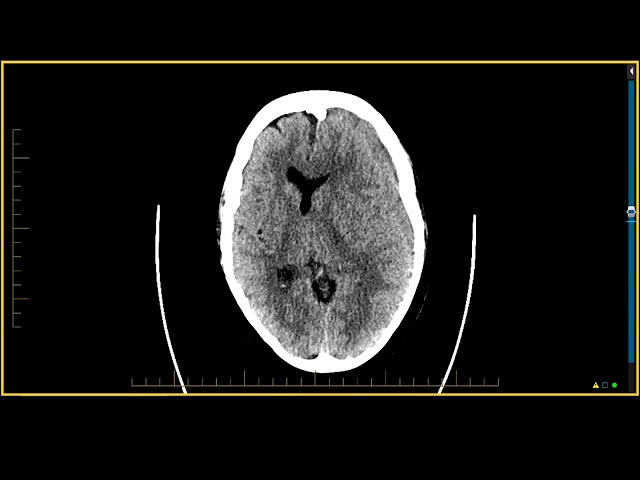 Intraparenchymal Hemorrhage With Midline Shift
