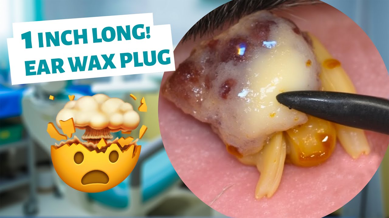 Rock Solid Ear Wax, Hairy Plugs & Impossible Canal Bends! || Thick, Dry ...