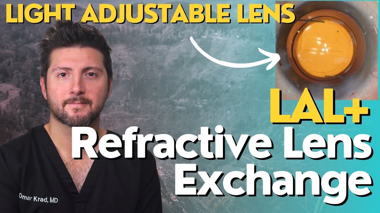Refractive Lens Exchange (RLE) Surgery with the Light Adjustable Lens ...