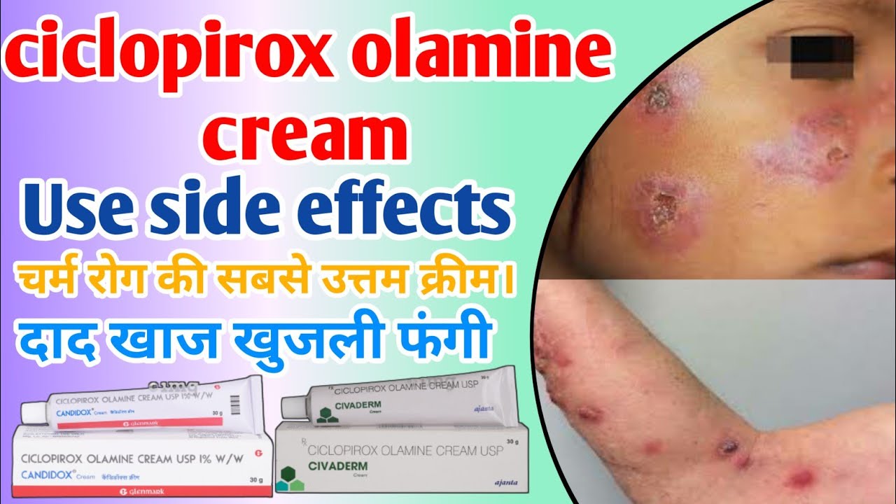 ciclopirox olamine cream usp 1 w/w use side effects dose ...