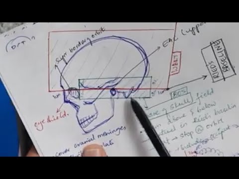 Prophylactic cranial irradiation, Craniospinal irradiation, German ...