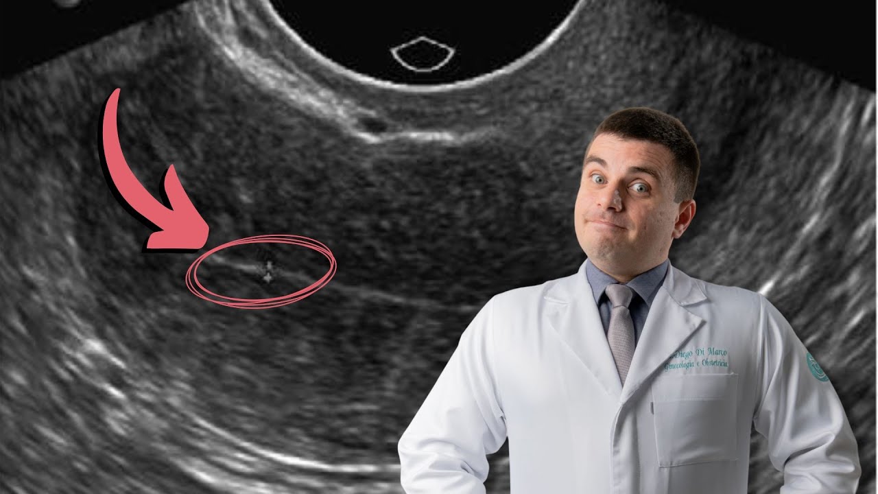 HIPERPLASIA endometrial: Sintomas, Causas e Tratamentos. - YouTube