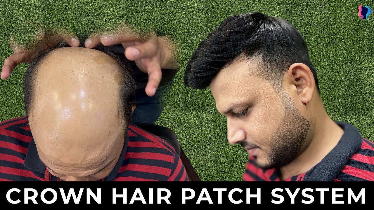 crown hair patch | hair loss treatment #hairpatch #hairloss - YouTube