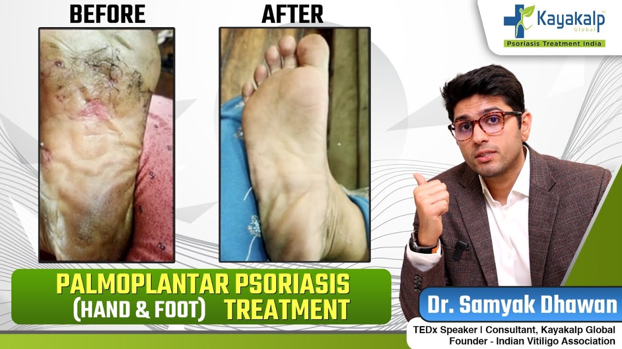 जानिए कैसे हुआ हाथो और पैरों के Psoriasis का इलाज | Palmoplantar (Hand ...