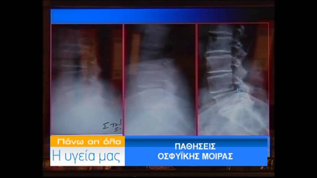 Εκφυλιστικές παθήσεις σπονδυλικής: Σπονδυλο-ολίσθηση & σπονδυλοδεσία ...