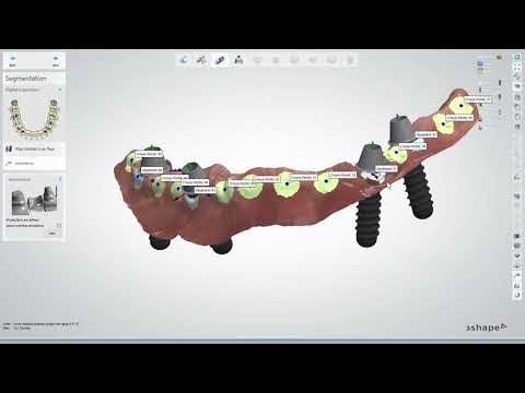 Workflow von Connect Case Center Inbox zu 3Shape: Implantatfall "All-on ...