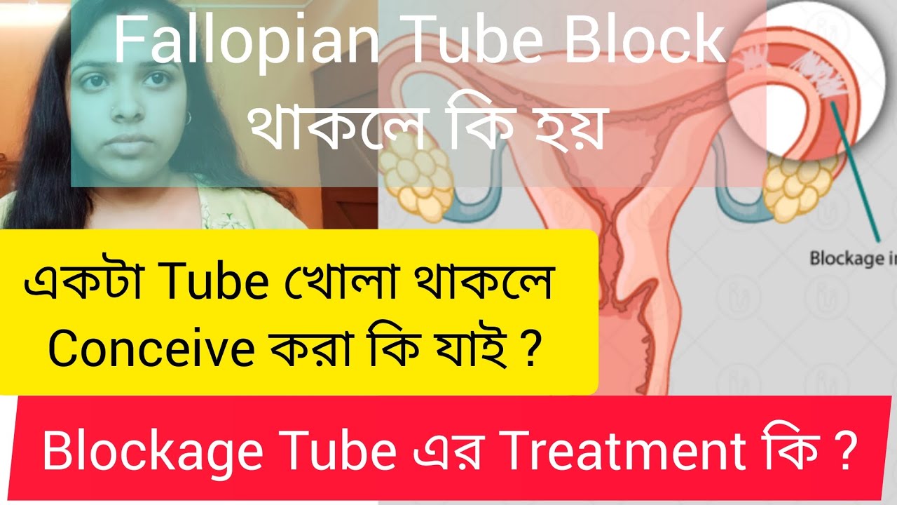 Fallopian Tube Block থাকলে কি হয়/ Fallopian Tube Block এরTreatment কি ...