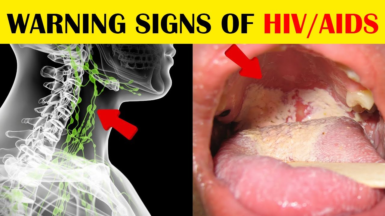 Spotting the Early Signs of HIV AIDS || 8 Common Signs of HIV Positive ...