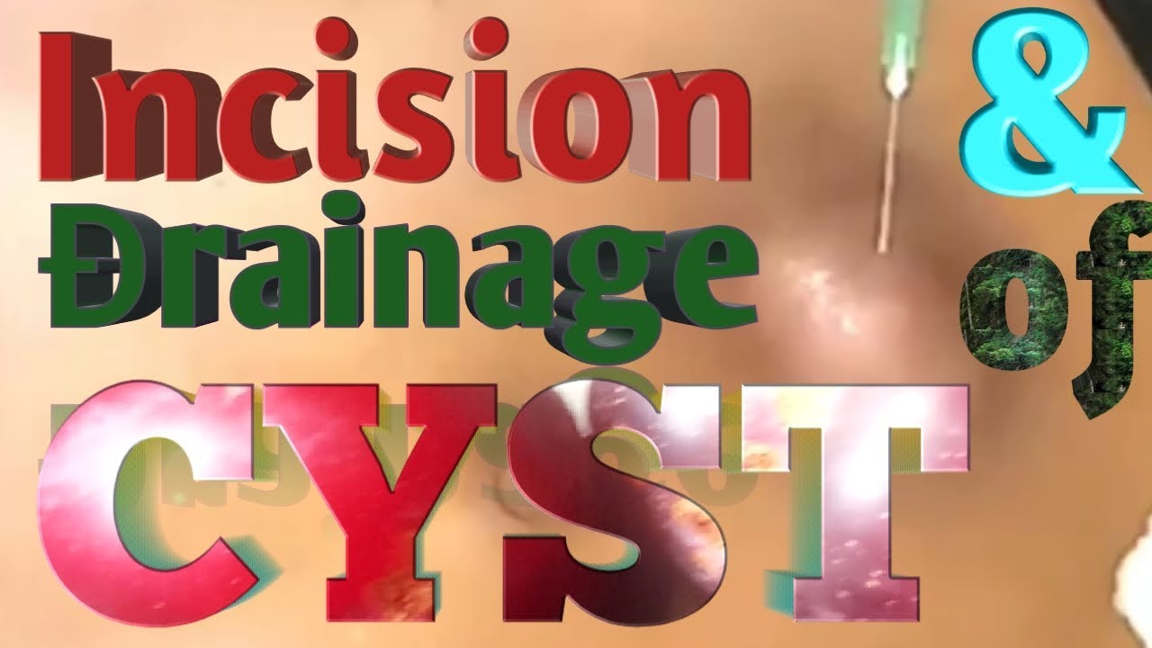 cyst incision and drainage // Boils I&D on abdomen - YouTube