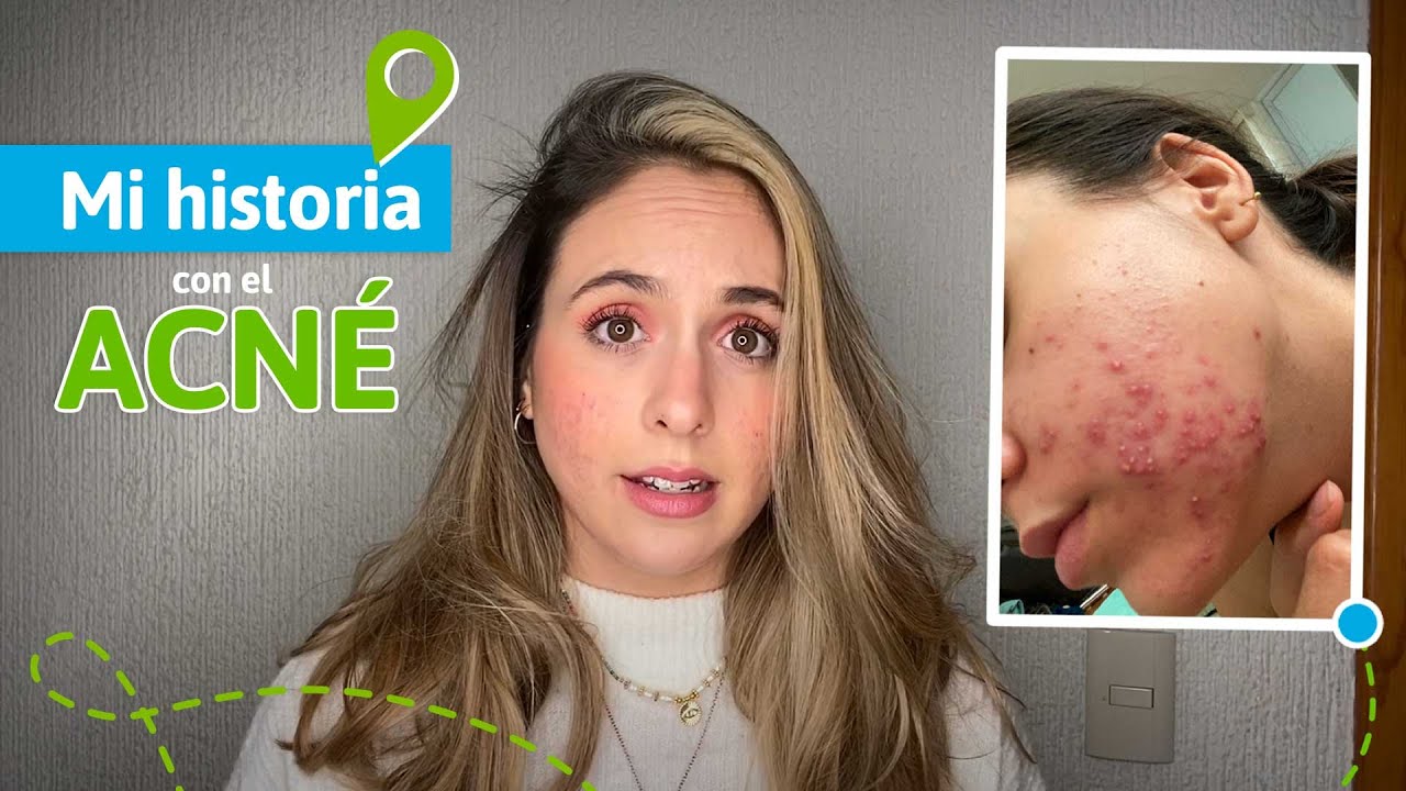 EP 1. Mi historia con el ACNÉ | Karla Esquivel | ¿Qué hacer y no hacer ...