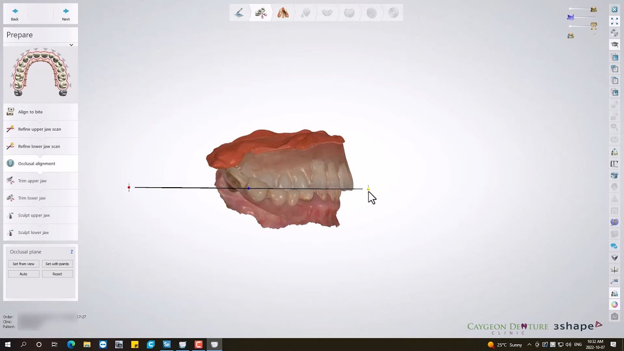 CUD Reference Denture Design - YouTube