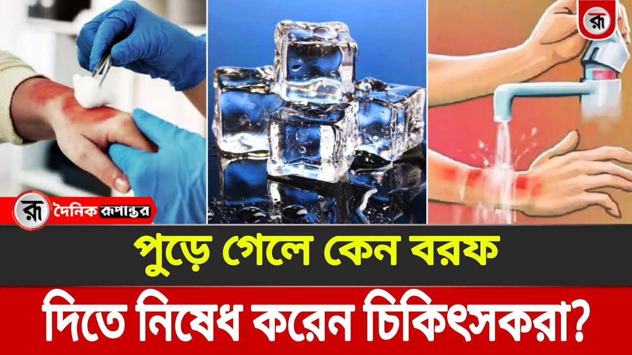 আ*গু*নে পু-ড়ে গেলে আপনিও বরফ দিচ্ছেন না তো? Fire Burn Tips | Ice ...