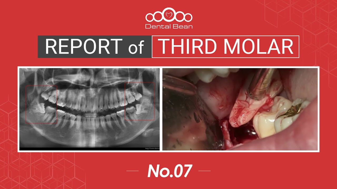[MULTI_SUB] Extraction of mesioangular Rt. & Lt Mn third molar - [Dr ...