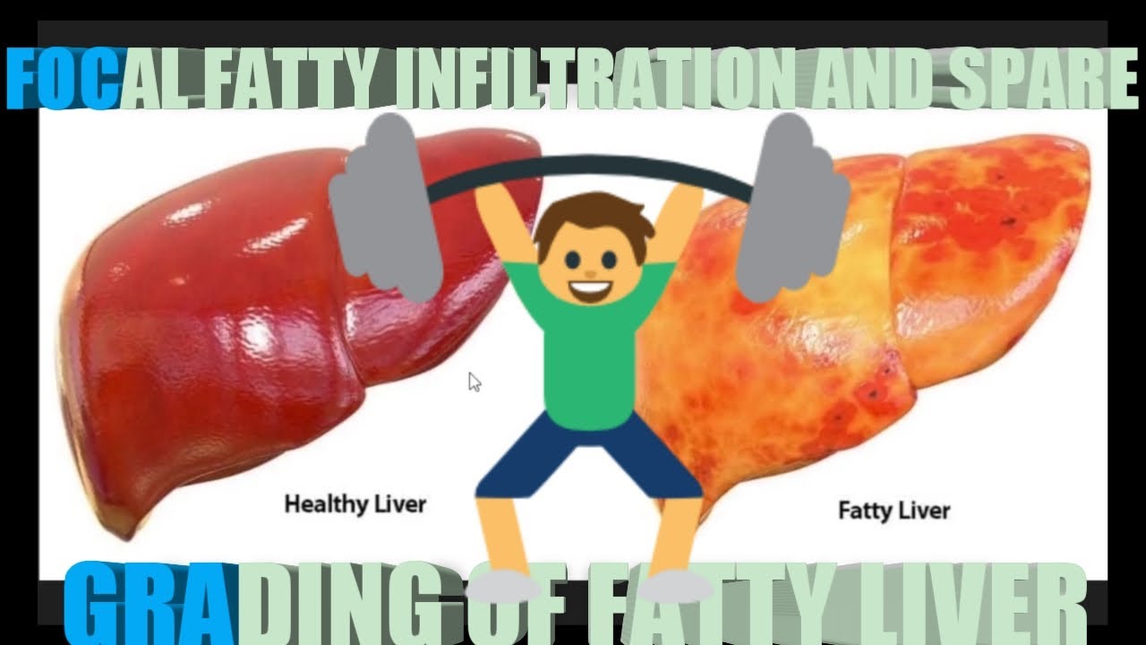 Fatty Liver Memes