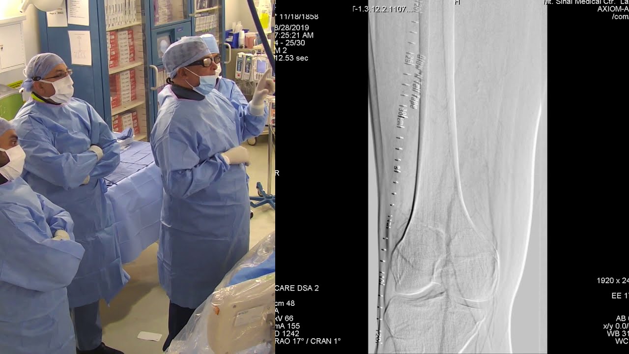 Peripheral intervention live webcast - August 2019 - YouTube