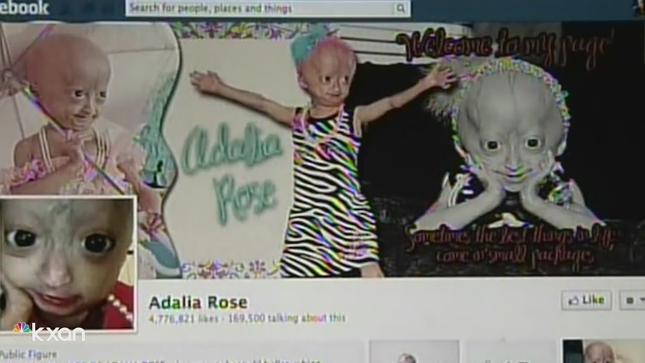 Adalia Rose: Austinite, social media star with rare genetic condition ...