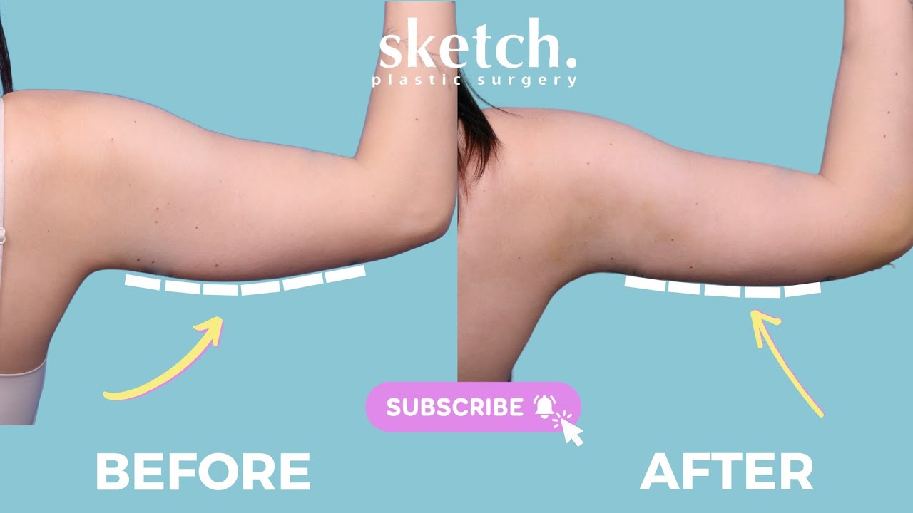 Fat Grafting & Liposuction: Get Rid of Stubborn Fat | Surgery at Sketch ...