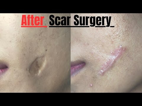 Scar revision surgery| Cheek scar - result after scar revision surgery ...