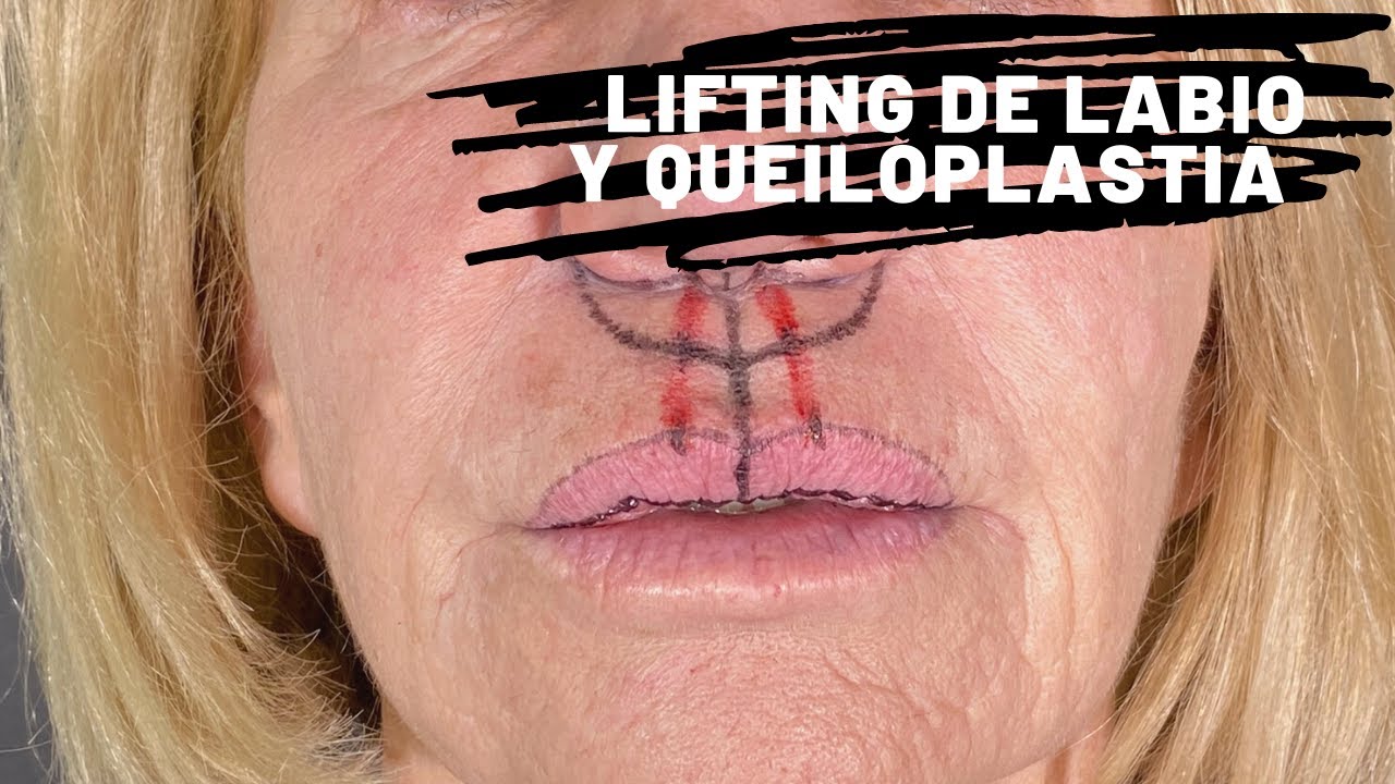 LIFTING DE LABIO SUPERIOR Y QUEILOPLASTIA: ANTES DESPUÉS Y TÉCNICA ...