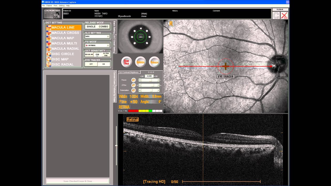 RS3000 Advance Scans.Regular, Fine, Ultra-Fine.wmv - YouTube