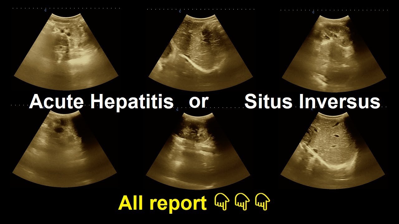 Situs inversus | Acute hepatitis | Ultrasound | Report | Amader ...