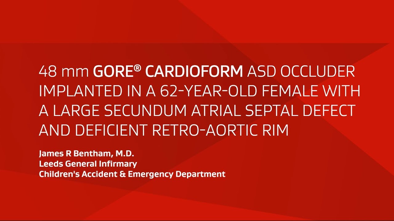 GORE® CARDIOFORM ASD Occluder implant in a large secundum ASD and ...