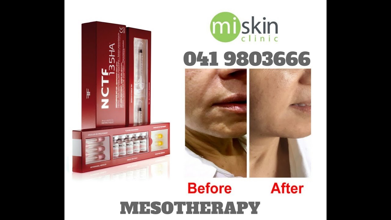 Filorga NCTF Mesotherapy - YouTube