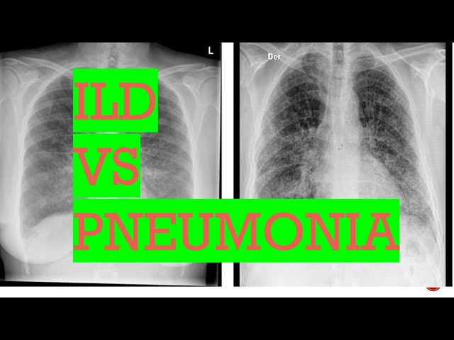 Interstitial Pneumonia X Ray