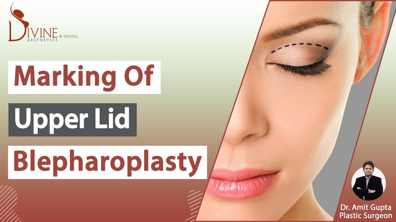 Marking of Upper Lid Blepharoplasty - YouTube