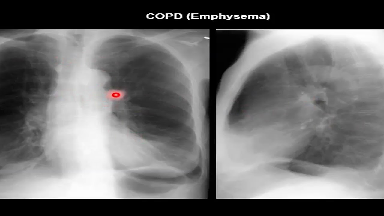 Introduction to Chest Imaging (Part 2 Pathology) - YouTube