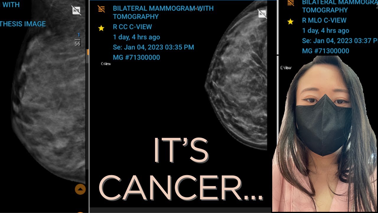 Breast cancer diagnosis story | Misdiagnosed | Mammogram + ultrasound ...