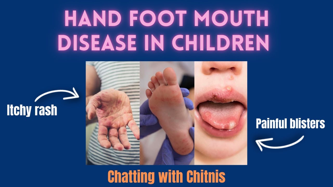 Hand Foot And Mouth Disease In Children YouTube