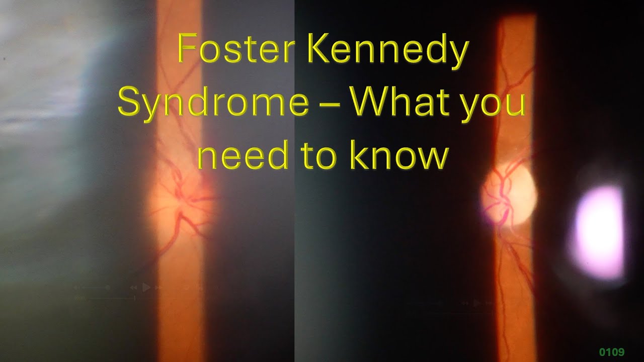 0109: Foster Kennedy Syndrome - What you need to know - YouTube