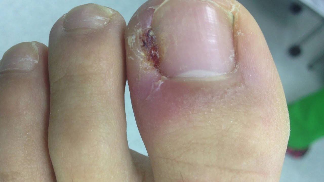 Cirugía uña encarnada - Dermatología en Bogotá - YouTube