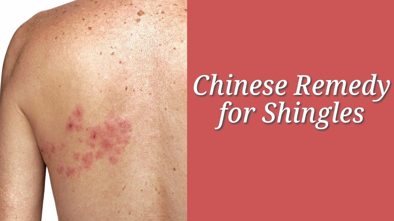 Chinese Remedies for Relieving Shingles - YouTube