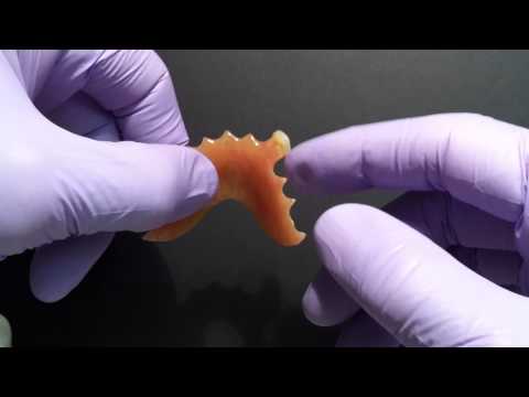 What Is A Stay Plate In Dentistry