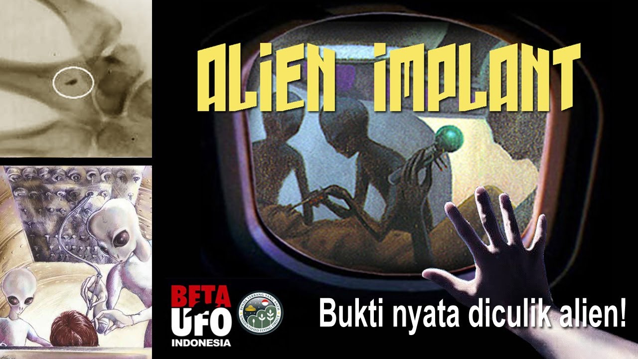 Alien implant bukti fisik alien abduction | Studi Ufologi - YouTube