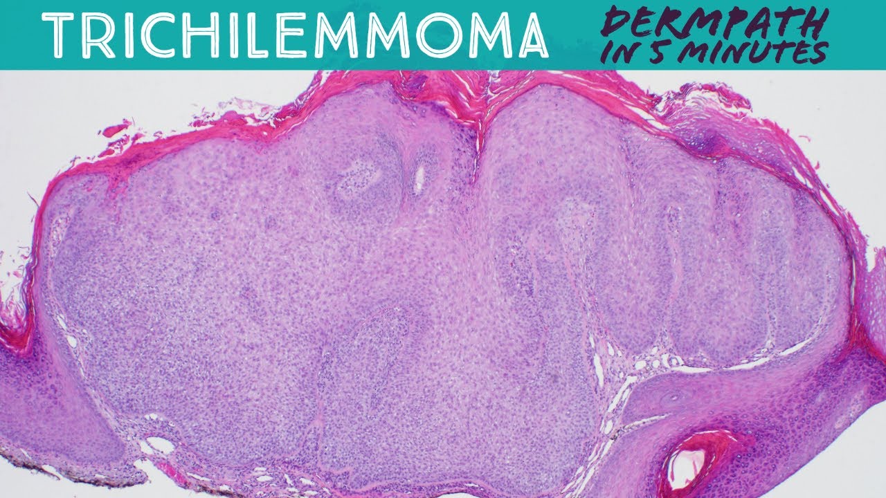 Trichilemmoma (mimic of wart): Dermpath in 5 Minutes (dermatology ...