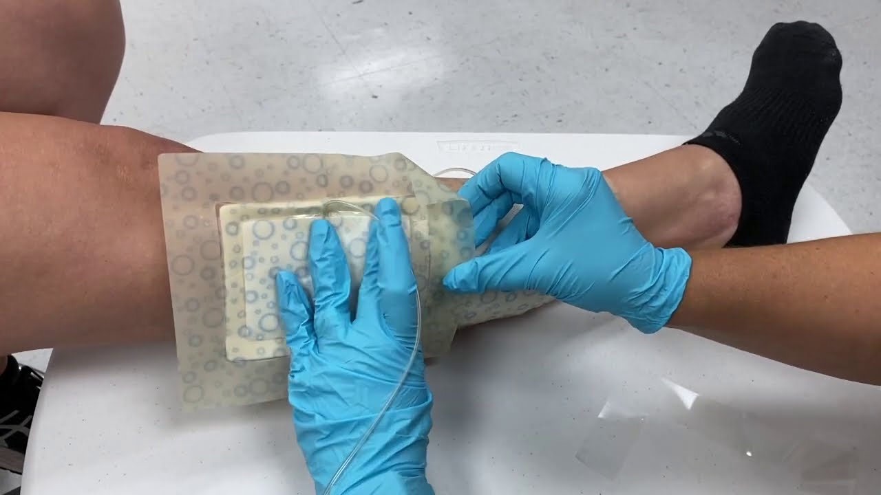 Covering a Large Wound with 2 OxySpur Dressings - YouTube