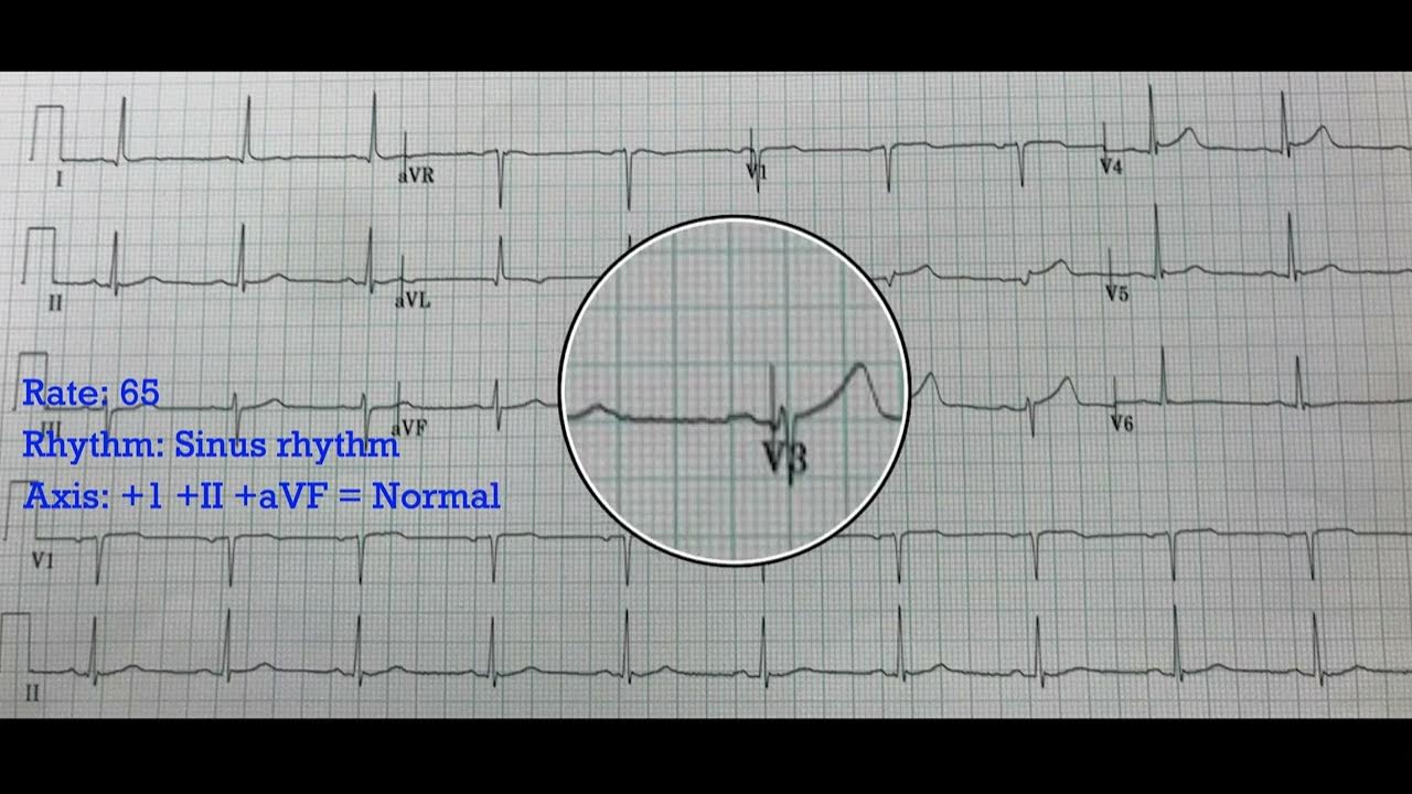 EKG of the week #7 - YouTube