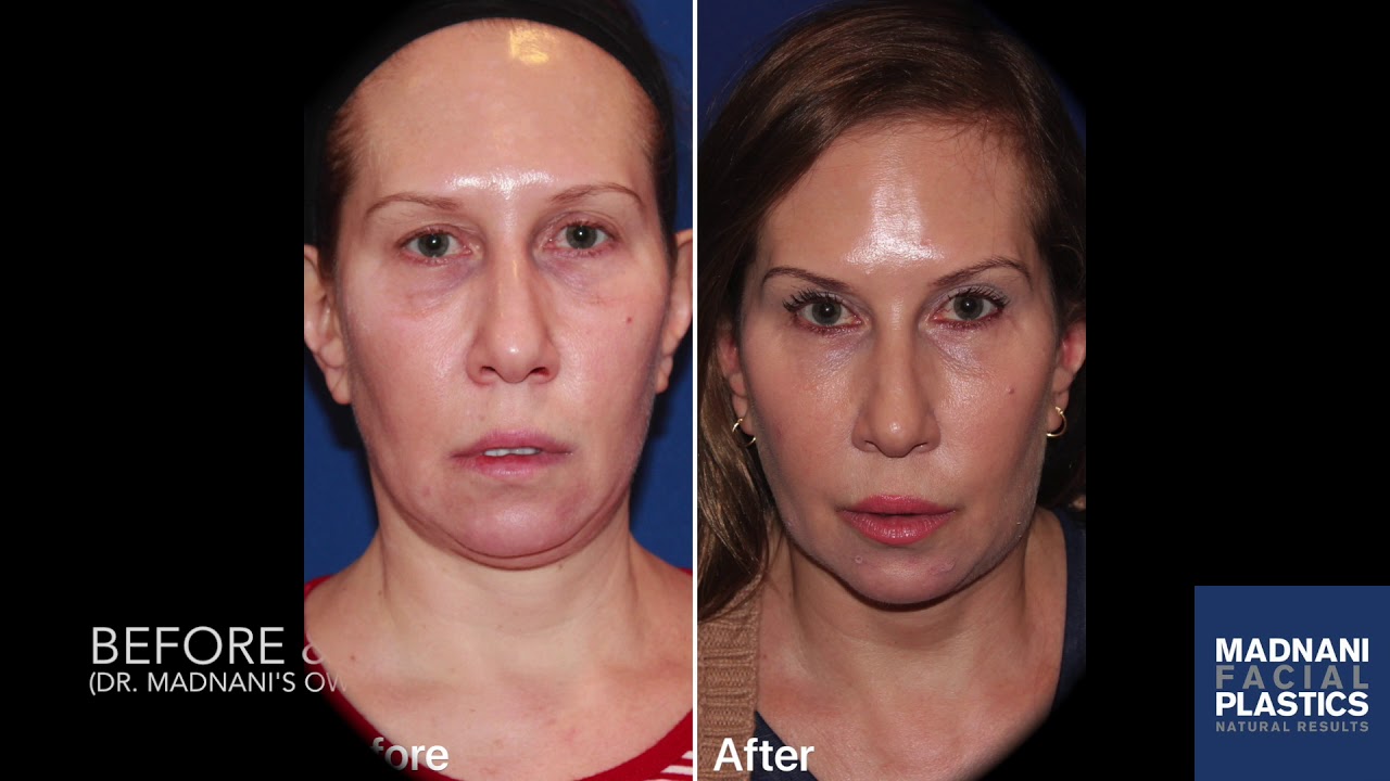 Ultherapy Treatment with Before & Afters - YouTube