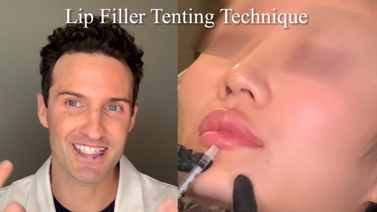 Lip Filler: Heart shaped Lips (Needle & Tenting Technique) - YouTube