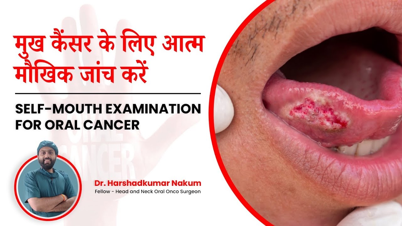 How to Do an Oral, Head and Neck Cancer Self-Exam | Self-mouth ...