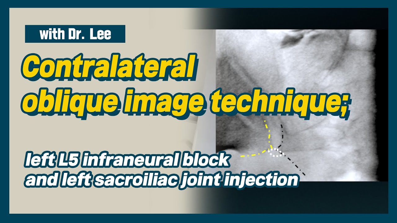 Learn contralateral oblique image C-arm anatomy: SIJ and infraneural ...