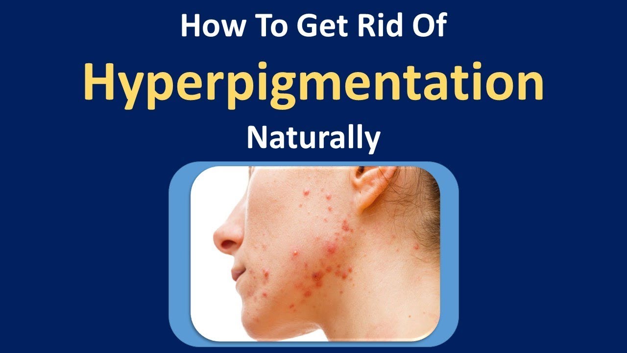 how to get rid of hyperpigmentation naturally | Apple Cider Vinegar ...