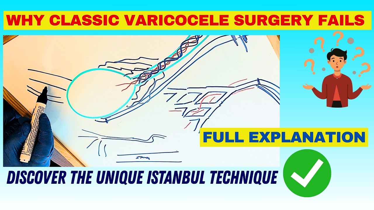 How We Treated Bilateral Varicocele with the Istanbul Technique ? Full ...